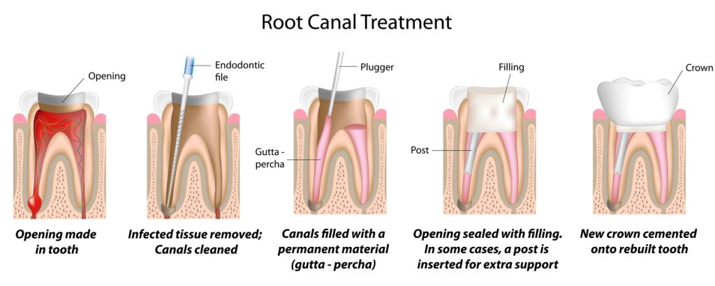 Root Canal Treatment Wanaka NZ | Root Canal Work Wanaka